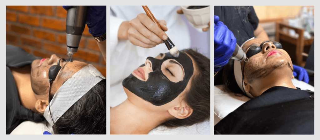What Makes Carbon Facials The Latest Skincare Trend?